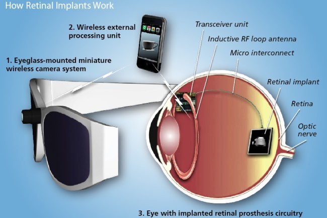 Electronic retinal implants — Are.na