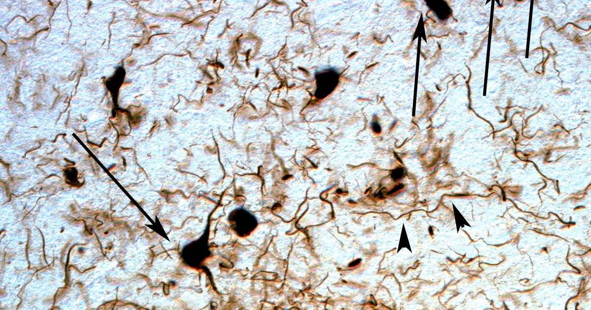 Visual Spatial Dysfunction | Are.na